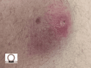 Surgical Cyst Removal and Incision and Drainage of Infected Cyst ...