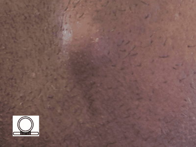 Surgical Cyst Removal and Incision and Drainage of Infected Cyst ...