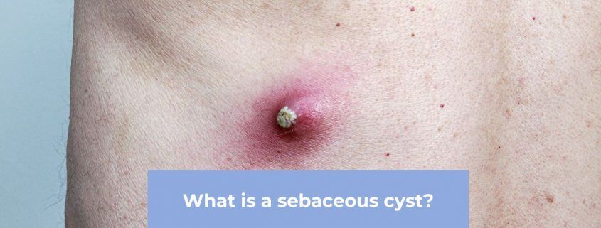 What is a sebaceous cyst? How do you remove sebaceous cysts?